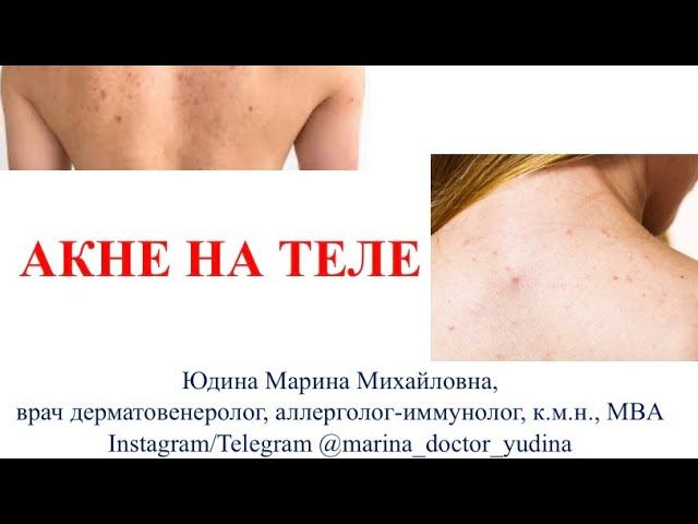 БЕСПЛАТНО полная лекция по лечению АКНЕ НА ТЕЛЕ (55мин)