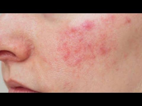 Ретиноиды при Папуло-пустулезной Розацеа