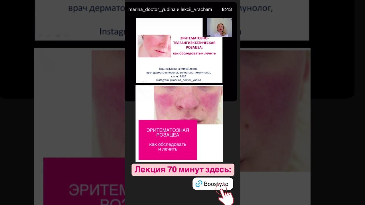 ЭРИТЕМАТОЗНАЯ РОЗАЦЕА