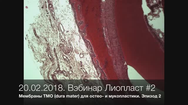 Использование ТМО (dura ma-ter) как мембраны и мукоплас-тического материала. Часть 2