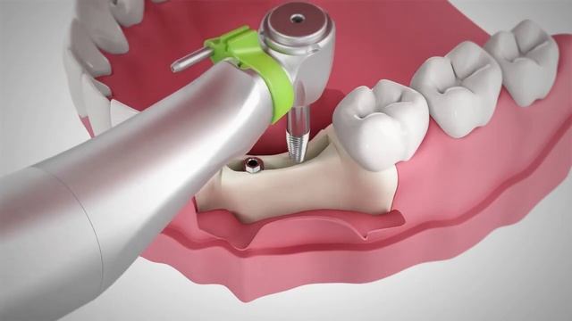 W&H Piezomed расширение альвеолярного отростка и удаление костной массы