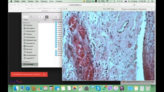 Использование ТМО (dura ma-ter) как мембраны и мукоплас-тического материала. Часть 5