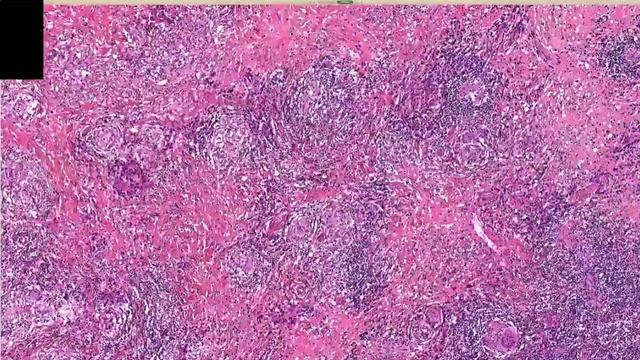 болезнь крона кожный полип при заболевании