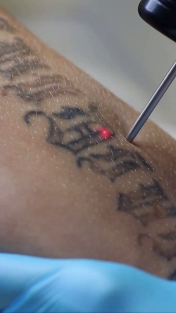 Удаление татуировок на единственном пикосекундном лазере PicoStar