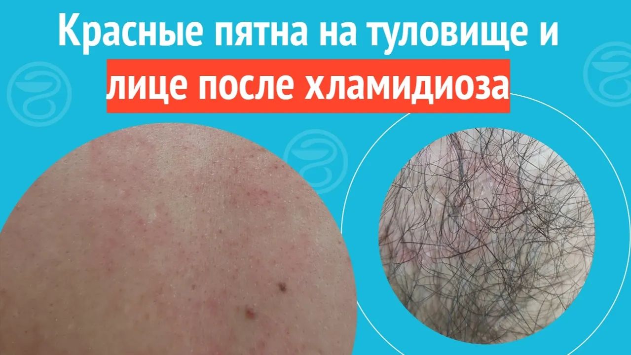 😨 Кондиломы на лобке и основании члена. Клинический случай №1449