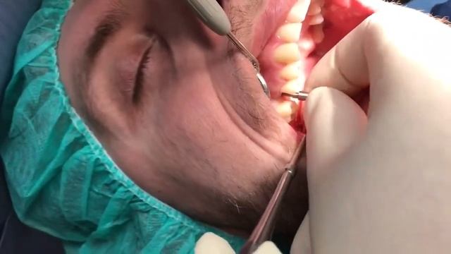 Penguin RFA - аппарат для измерения стабильности дентальных имплантатов.