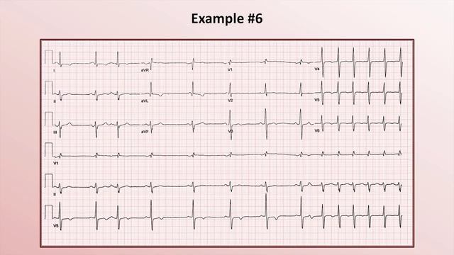 11 Intro to EKG Interpretation - Practicing Tachyarrhythmia Identification Eric Strong