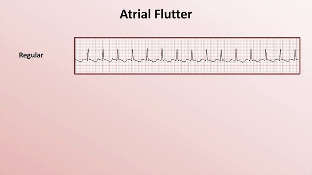 09 Intro to EKG Interpretation - Overview of Tachyarrhythmias