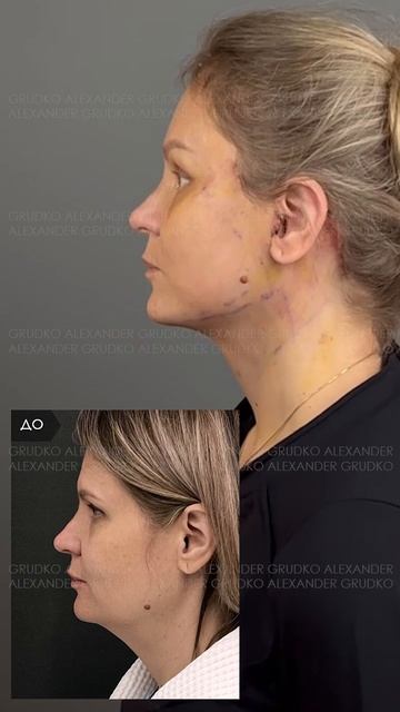 10 дней после пластики лица