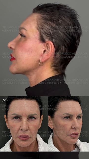 Повторная пластика лица