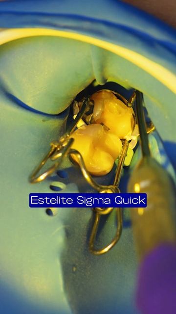 Восстановление жевательного зуба текучим композитом #Estelite #стоматология #реставрация #зубы