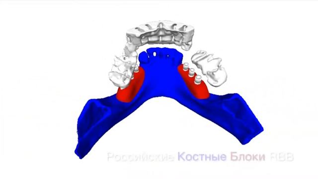 Индивидуальные костные блоки RBB (Россия) по 3Д-Компьютерной томографии