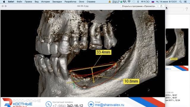 Индивидуальные костные бло-ки Russian Bone Blocks для ре-конструкции челюстей. Часть 1