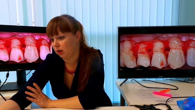 Лечение рецессий десны 10.11.17. Носова Мария. Эпизод 18