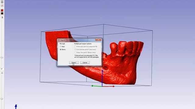 Создание 3Д-моделей по dicom для моделирования индивидуального блока RBB