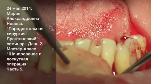 Хирургическое пародонтологическое лечение. Базовый курс. Часть 10