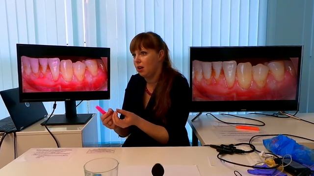 Лечение рецессий десны 10.11.17. Носова Мария. Эпизод 19