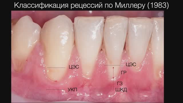 Хирургическое лечение рецессии десны 1.2