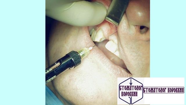 Инфильтрационная анестезия для имплантации  области 12.