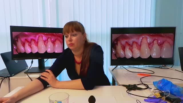 Лечение рецессий десны 10.11.17. Носова Мария. Эпизод 20