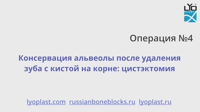 Операция №4 Консервация альвеолы после удаления зуба с кистой на корне: цистэктомия