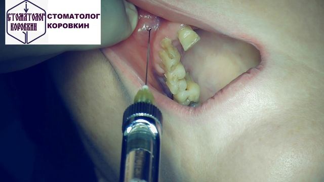 Инфильтрационная анестезия для удаления 12.