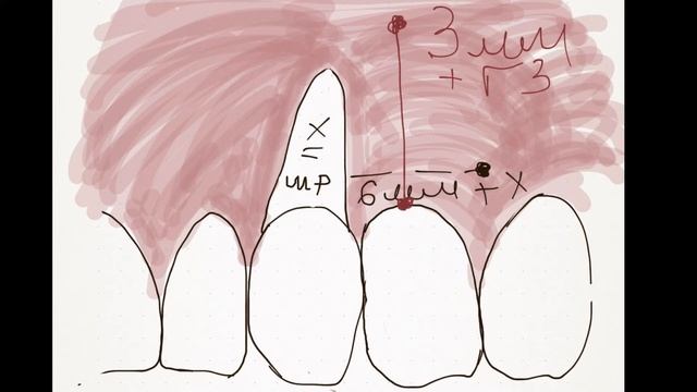 Хирургическое лечение рецессии десны 2.1