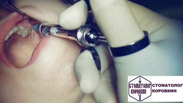 Инфильтрационная анестезия для экстракции и имплантации 26,27.