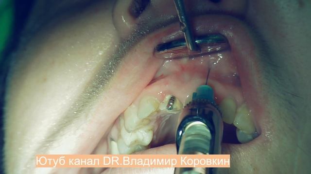 Инфильтрационная анестезия для лечения 11,21.Инфильтарционная анестезия в стоматологии.