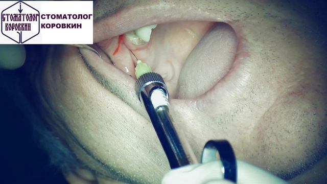 Инфильтрационная анестезия для экстрации 13 и имплантации  в области 13 и 15.