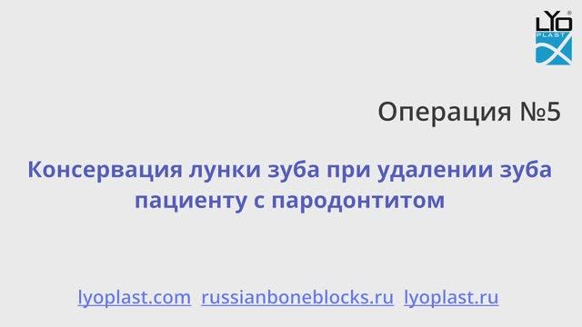 Операция №5 Консервация лунки зуба при удалении зуба пациенту с пародонтитом