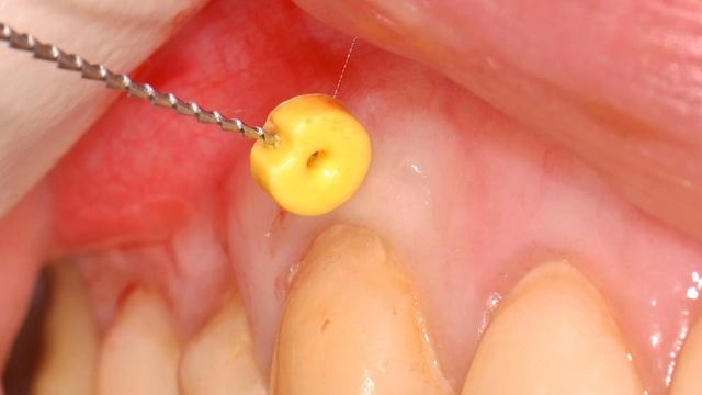 Хирургическое лечение рецессии десны 3.6