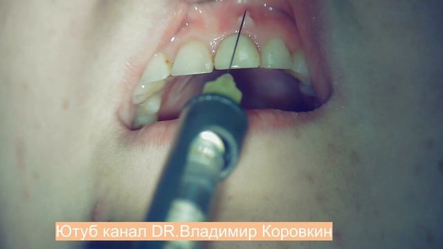 Ингфильтрационная анестезия для лечения 12,11,21.#Инфильтрационнаяанестезия#infiltrationanaesthesia