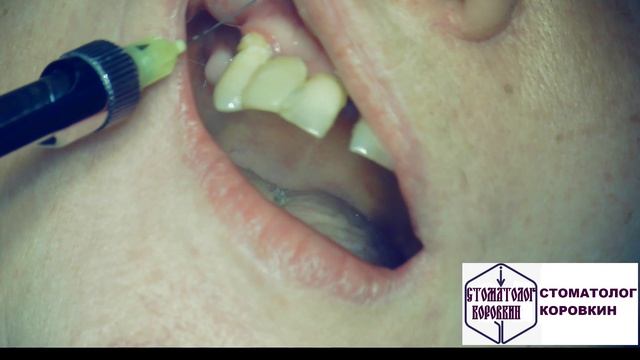 Инфильтрационная анестезия для имплантации 14.