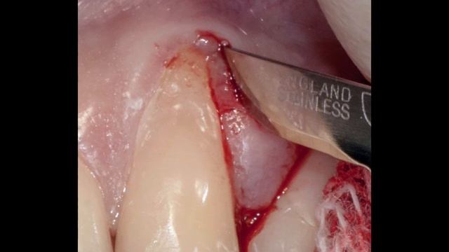 Хирургическое лечение рецессии десны 2.2