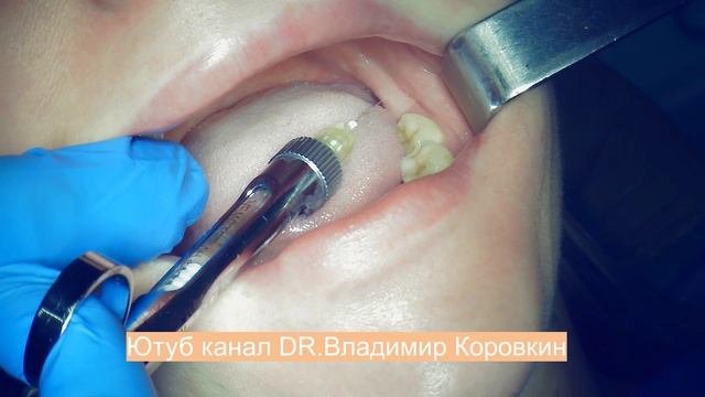 Проводниковая анестезия слева. Для иплантации область 37.