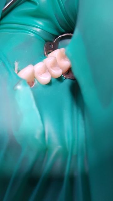 Раббердам изоляция 23-26 зубов.#раббердам#рабьбрдамология