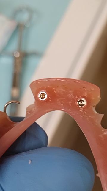 Перебазировка протез нижней челюсти.Фиксация замков T-ecco  в позиции 42 и 32 имплантов.