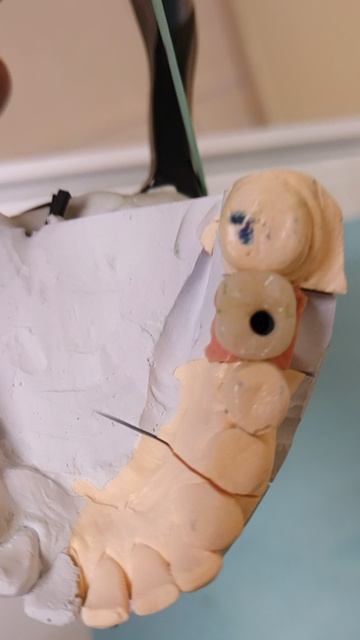 Металлокерамическая коронка на импланте 36. Винтовая фиксация.