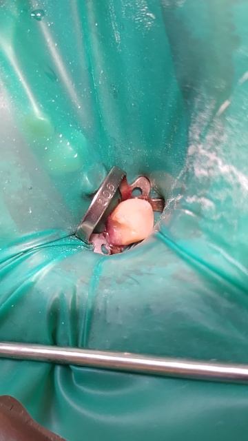 Одиночная раббердам изоляция 16 зуба.#раббердам#раббердамолония