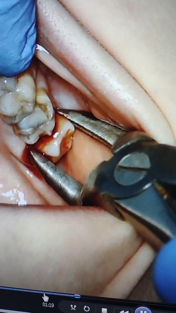 Экстракция 27 зуба.#удалениезуба #toothextraction