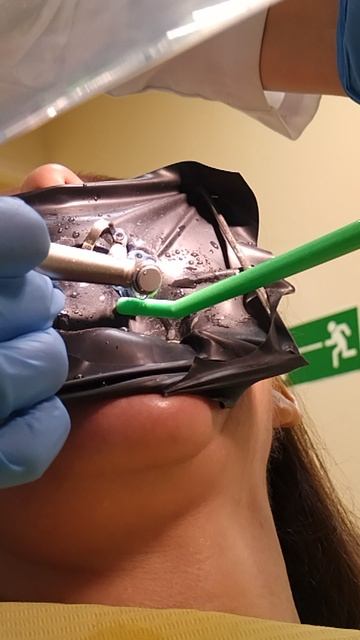 Препарирования кариозной полости с раббердаме.