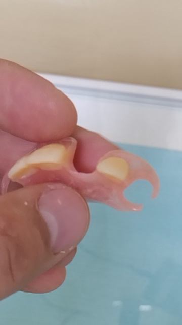 Частично съёмный пластиночный протез на пилотах. Замещение 11.12.22 зубов.