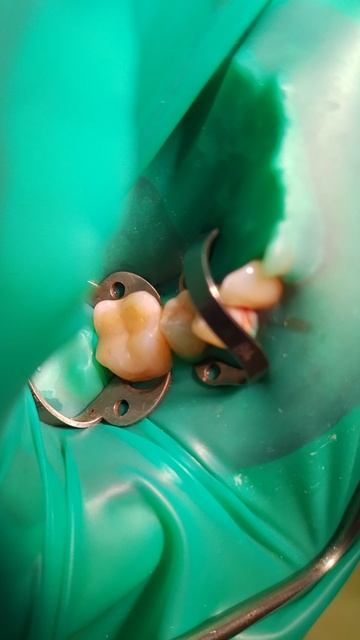 Раббердам изоляция 46-43 зубов.#раббердам#раббердамология