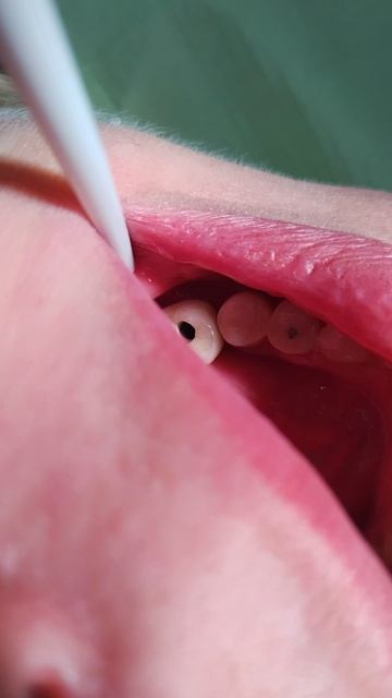 Металлокерамика на импланте 36 в полости рта.