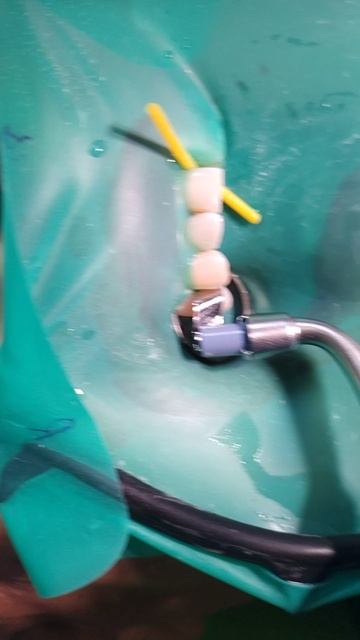 Установка матричной системы super mat Kerr Have.14 зуб.