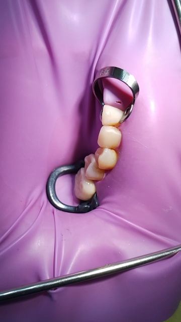 Раббердам изоляция с 46-42 зубов.