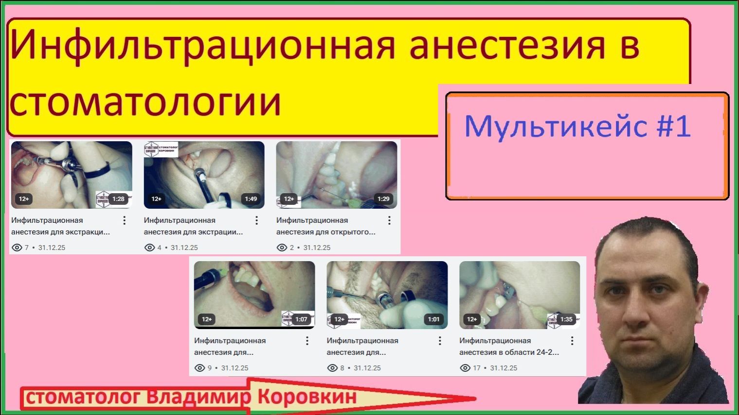 Инфильтрационная анестезия в стоматологии ( 27 минут). Мульти кейс #1.