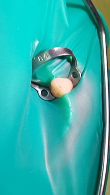 Одиночная раббердам изоляция 33 зуба.