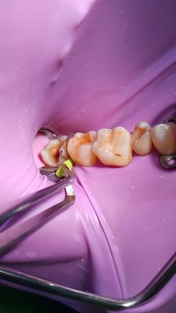 Межзубный клин с защитой.